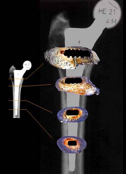 Il clodronato nella tutela dell’osso periprotesico – Ason